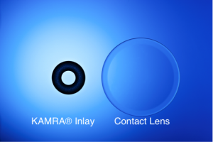 KAMRA Corneal Inlay | Treatment for Presbyopia - Whitten Laser Eye